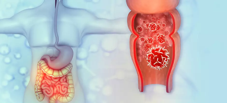 Early Detection Of Colorectal Cancer Importance Of Colonoscopy And